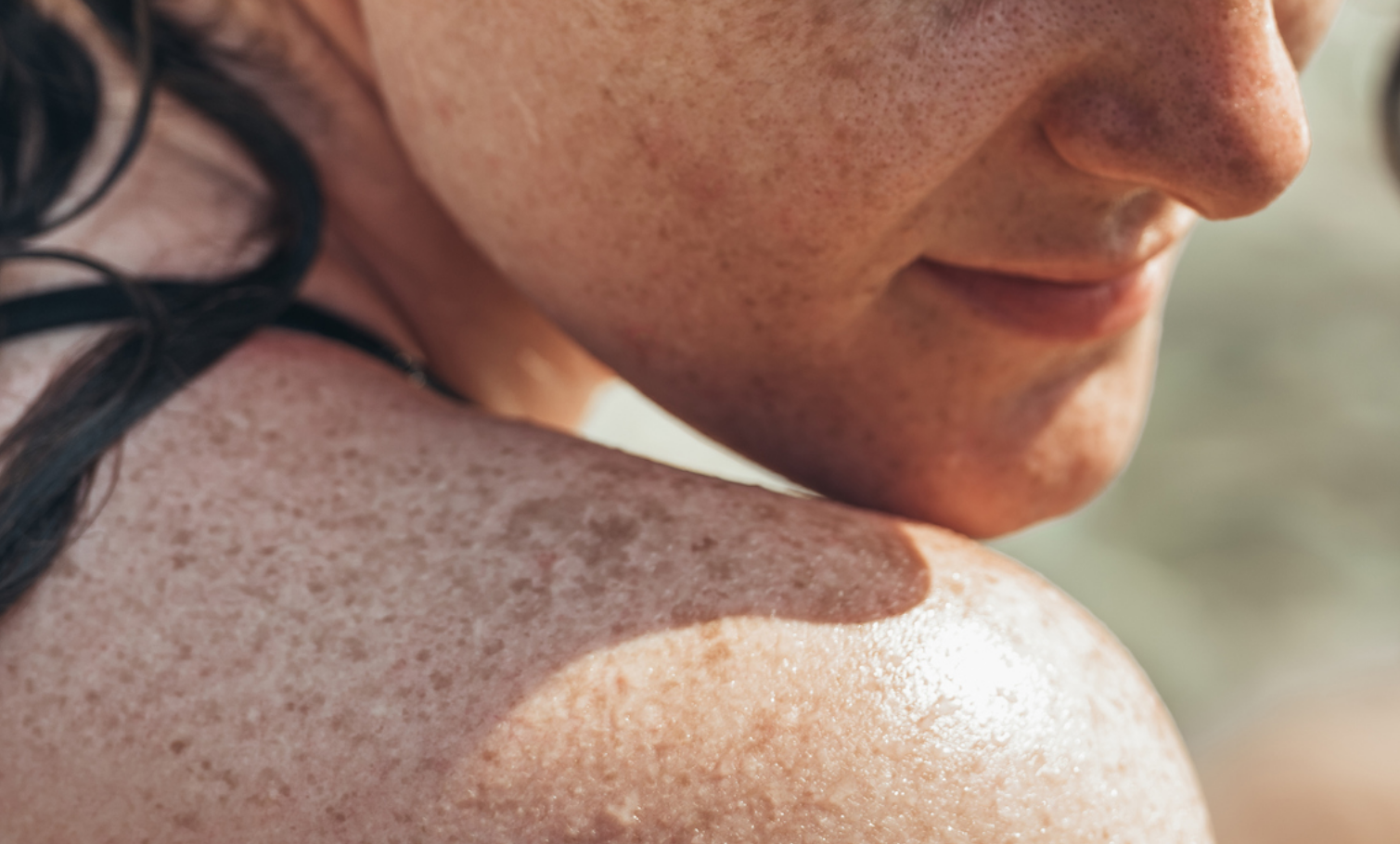 Everything You Need To Know About Hyperpigmentation - The Skin Lab