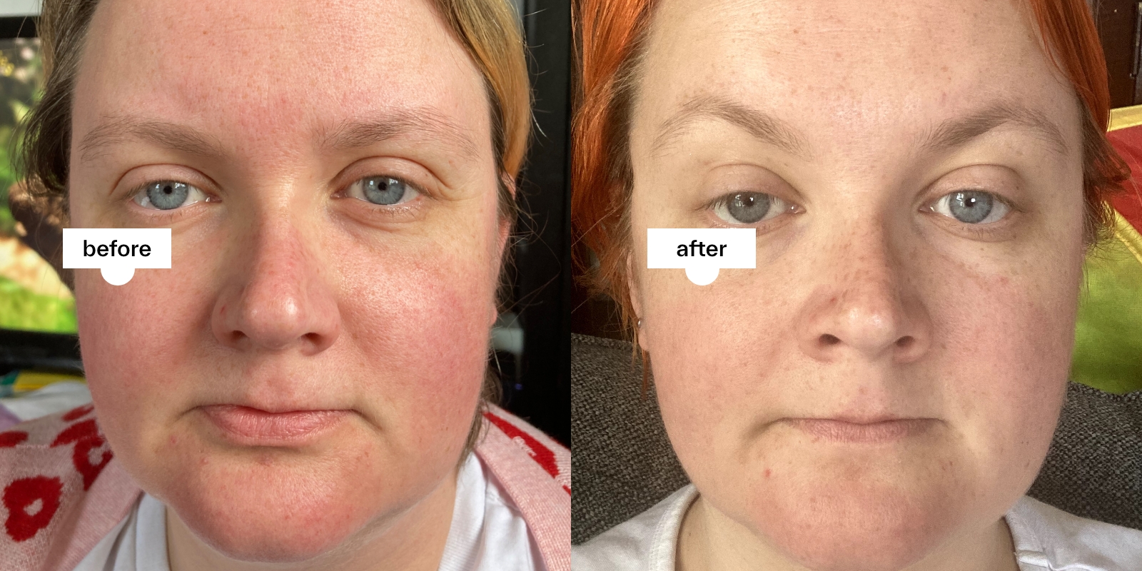 Rosacea Skin Journey: Alison, 38, Cumbernauld - The Skin Lab