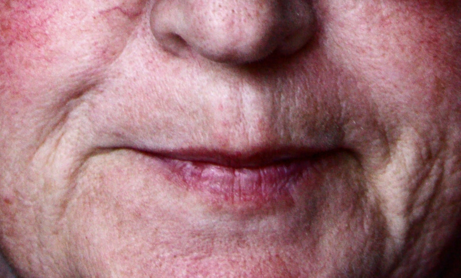 6 Easy Ways to Manage Winter Rosacea - SkinLab