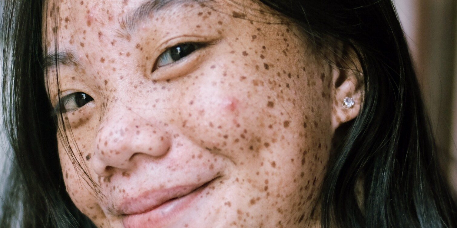 Retinoids: Why Skin Purges And How Long It Lasts - The Skin Lab