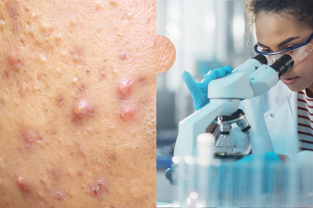 Adapalene vs. Tretinoin: Which Is Better For Acne & Anti-Ageing? - SkinLab