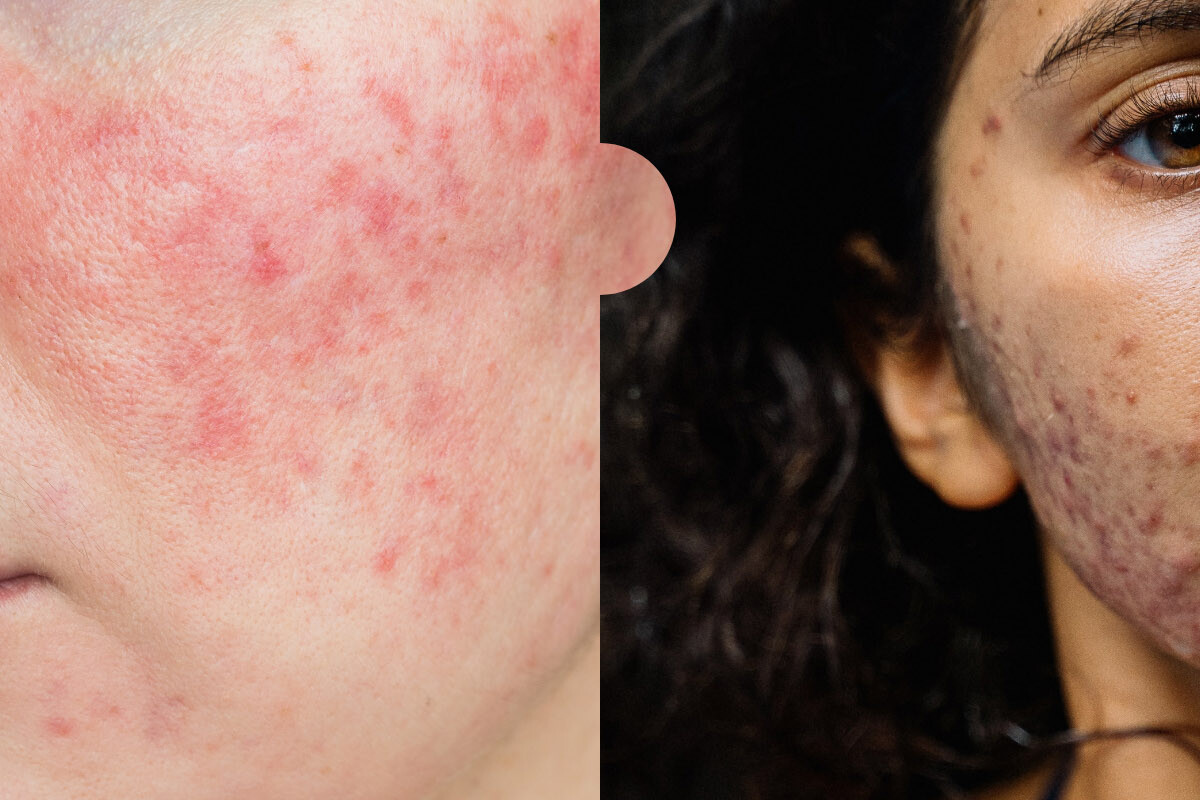 Your Treatment Guide To Acne