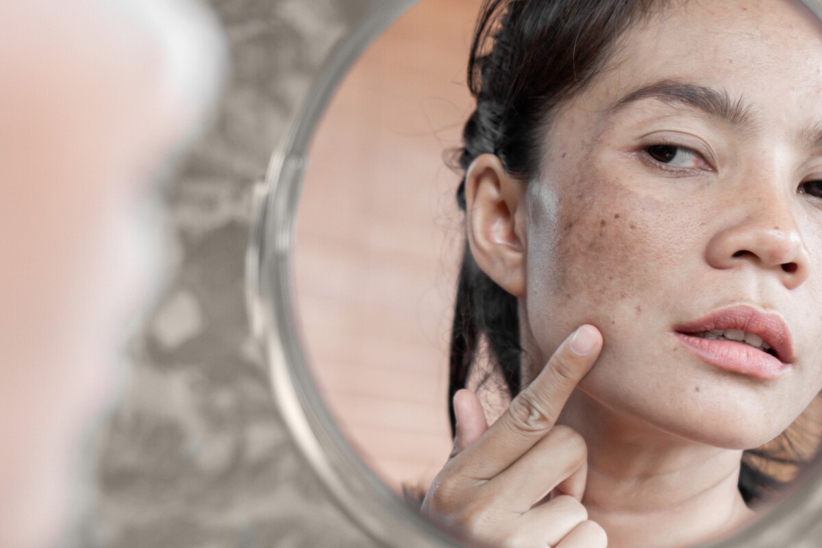 Pseudofolliculitis barbae: How to prevent spots in your beard - SkinLab