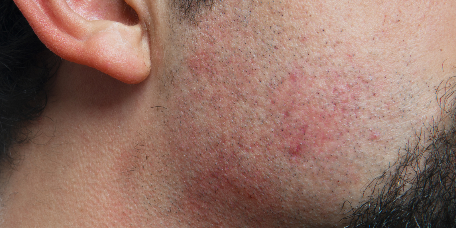 Pseudofolliculitis Barbae: How To Prevent Spots In Your Beard - SkinLab