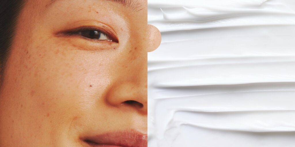 Tackling Hyperpigmentation With Hydroquinone Cream - SkinLab