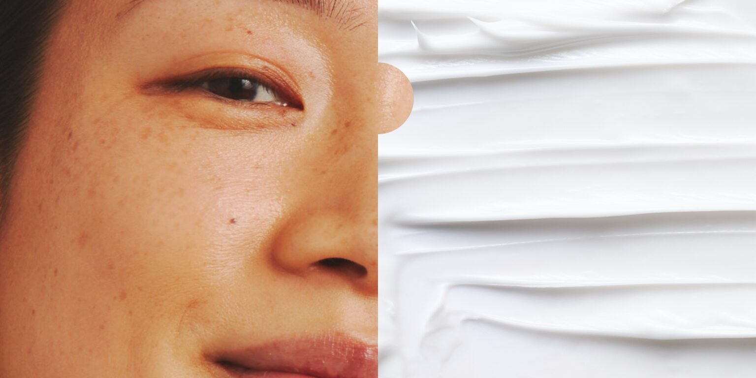 Tackling Hyperpigmentation With Hydroquinone Cream - SkinLab