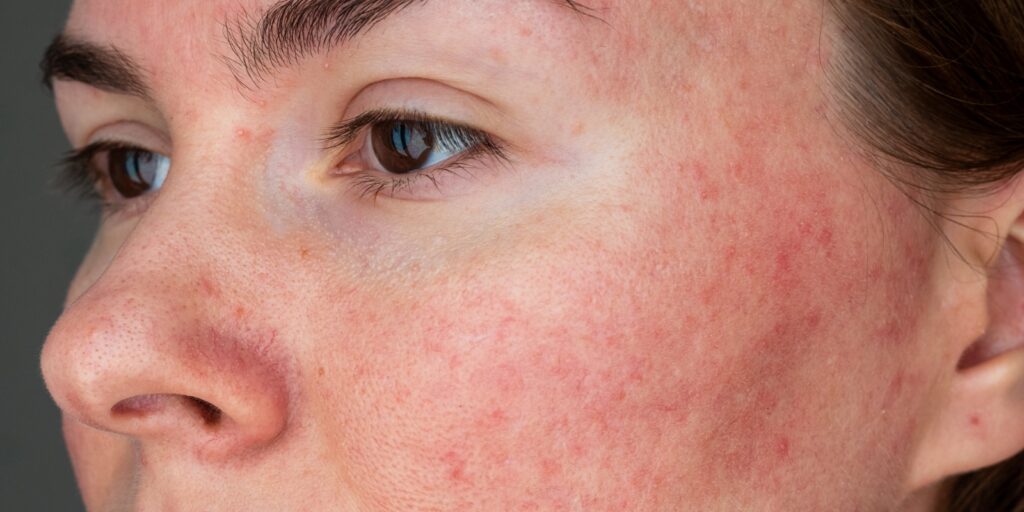 Rosacea Triggers: A Comprehensive Guide - SkinLab
