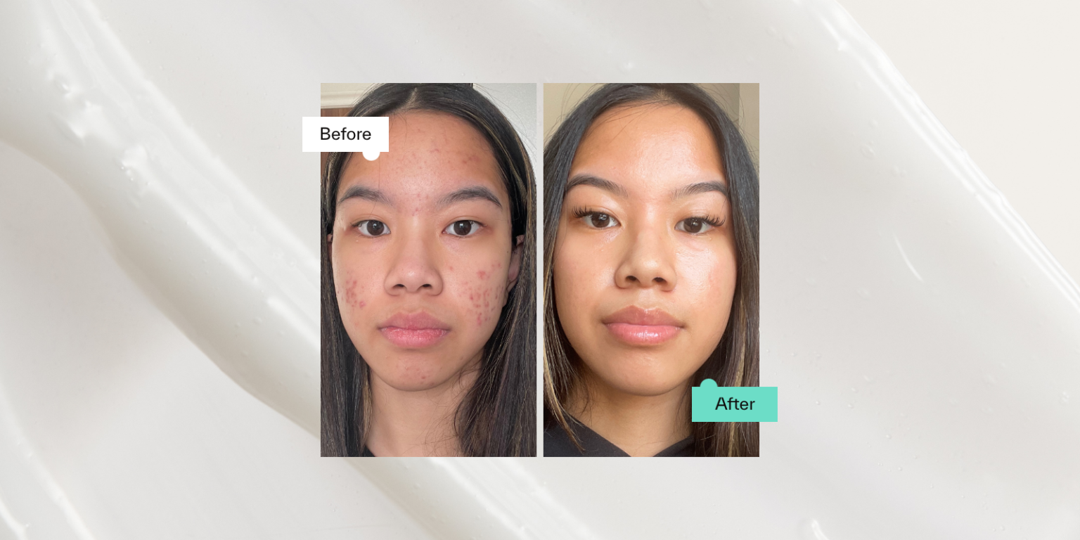 Treating Skin With Benzoyl Peroxide: Before And After - SkinLab