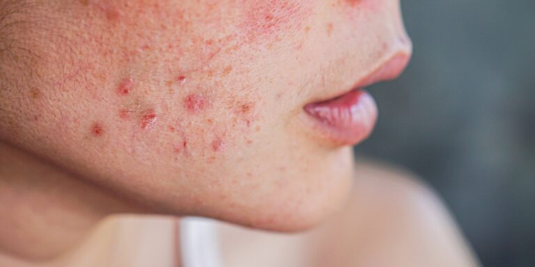 Cheek Acne: Causes, Treatment and Prevention - SkinLab