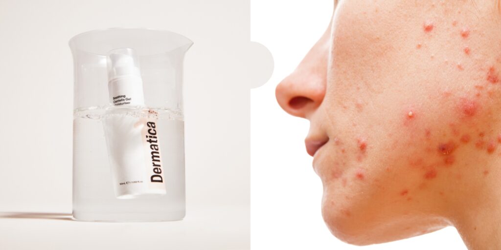 Hormonal Acne: The Ultimate Guide To Causes & Treatment - SkinLab