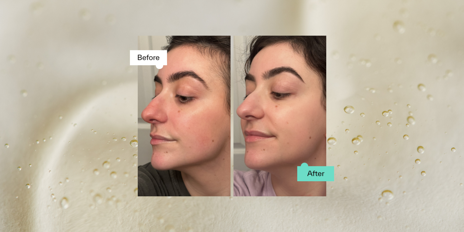Treating Skin With Hyaluronic Acid: Before And After - SkinLab