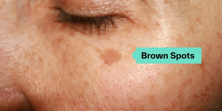Why are brown spots suddenly appearing on your skin? - SkinLab
