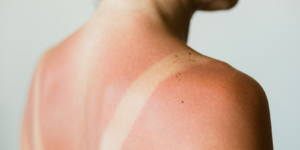 How To Recognise Sun Damaged Skin - SkinLab