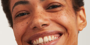 How To Recognise Sun Damaged Skin - SkinLab