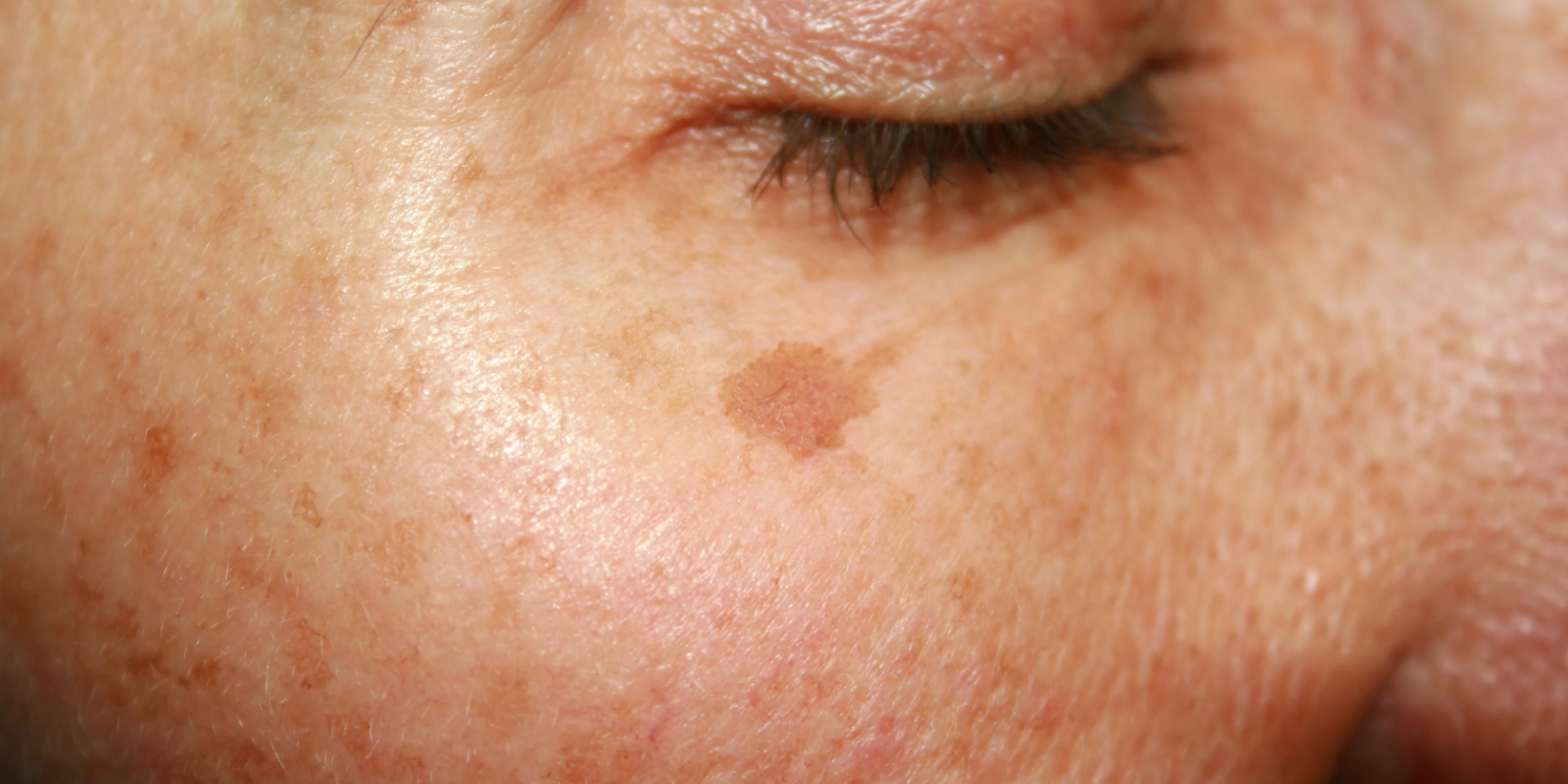 How To Recognise Sun Damaged Skin - SkinLab